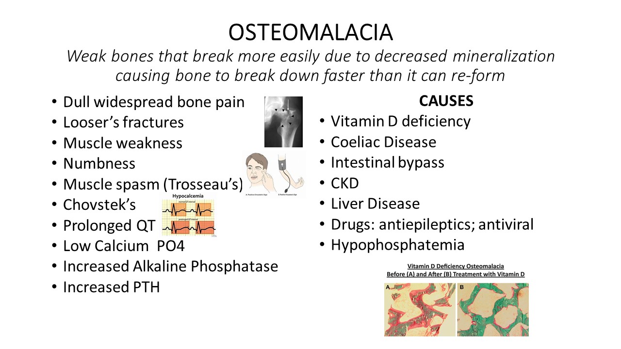 Osteomalacia In Adults