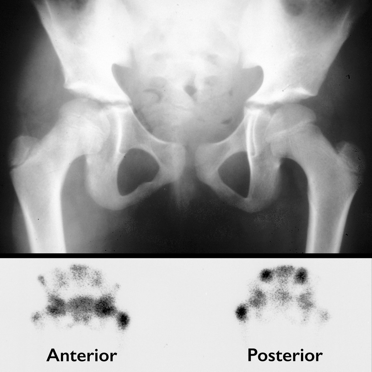 Osteomyelitis Röntgen