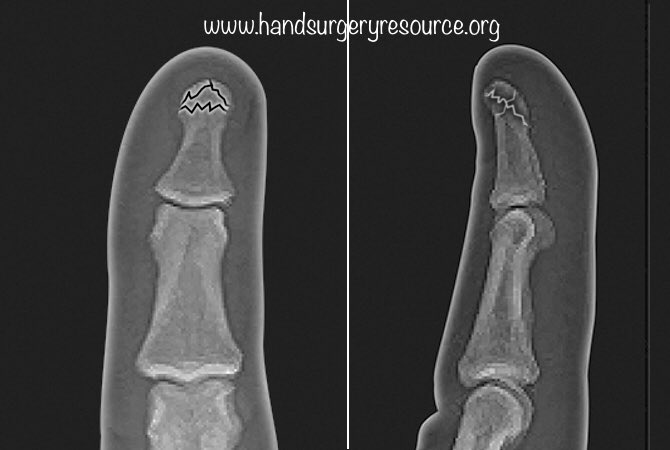 Distal Phalanx Tuft Fracture