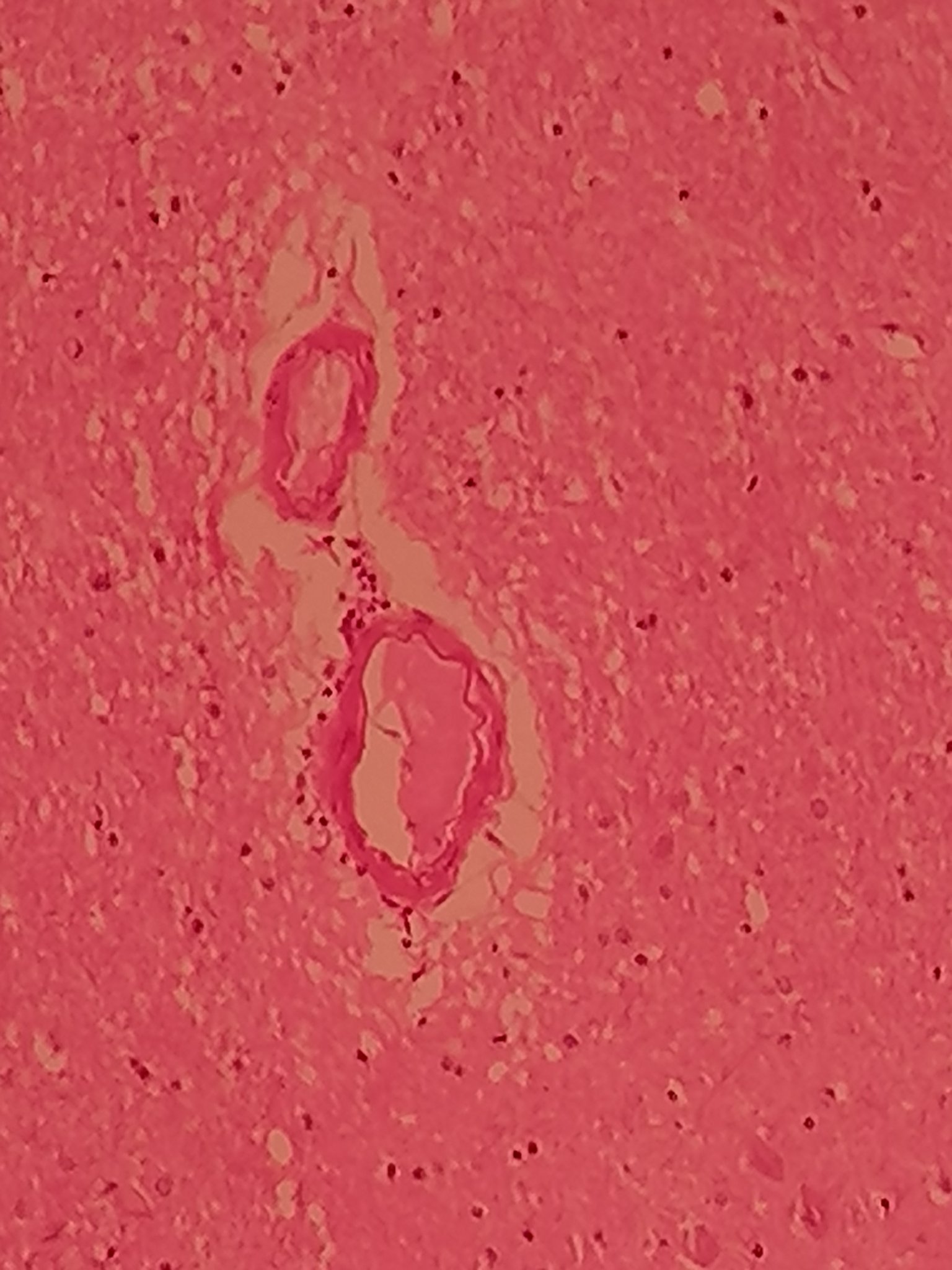 Hyperplastic Arteriosclerosis Arteriolosclerosis Wikipedia