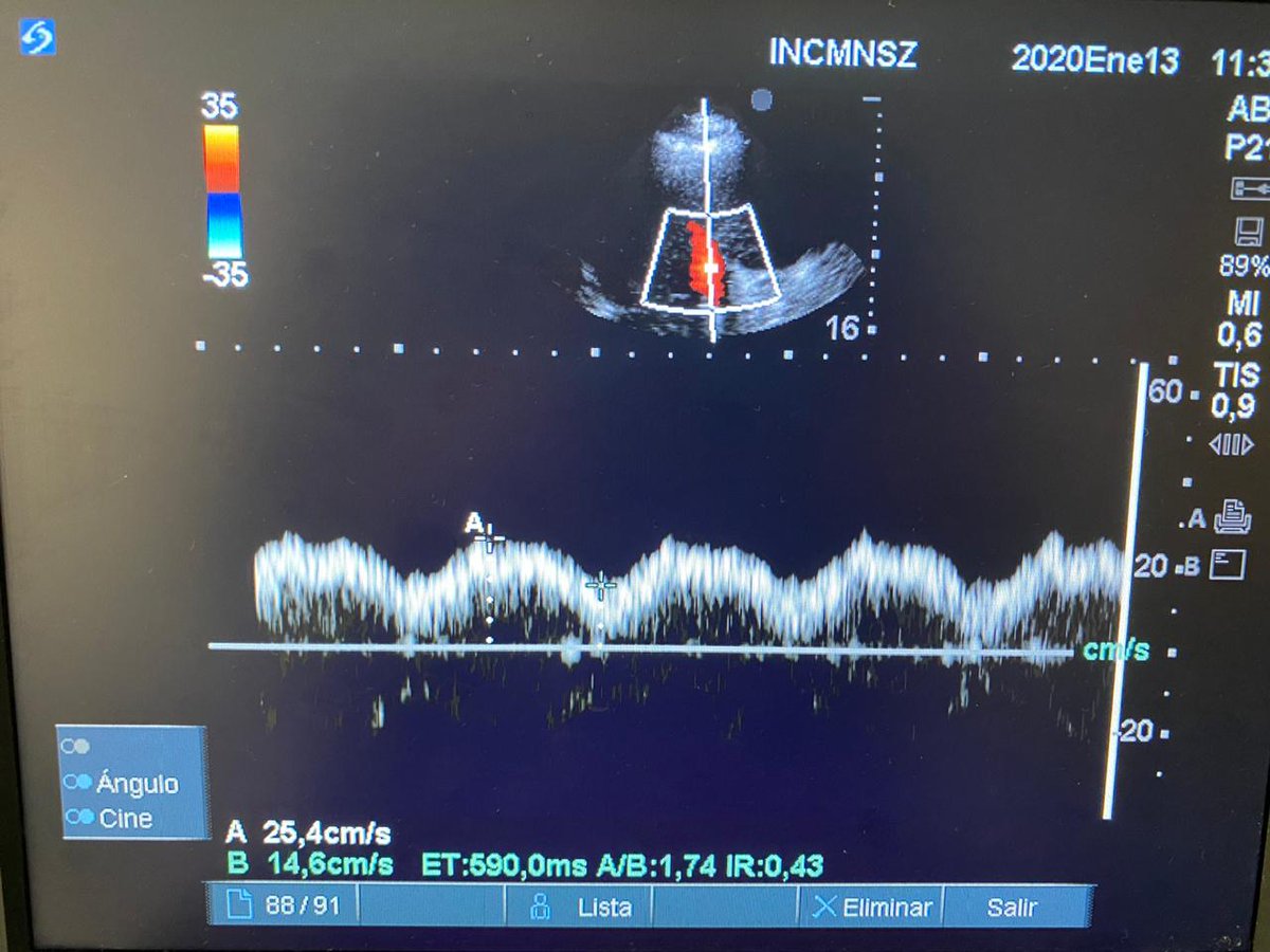 A Thread from @ArgaizR: "Pt w ischemic cardiomyopathy. Formal Echo from ...
