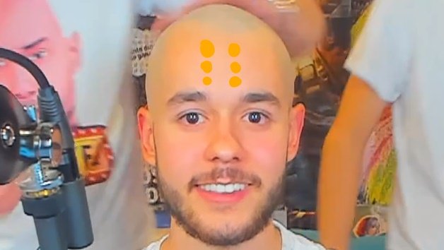 Donut Forehead Implant
