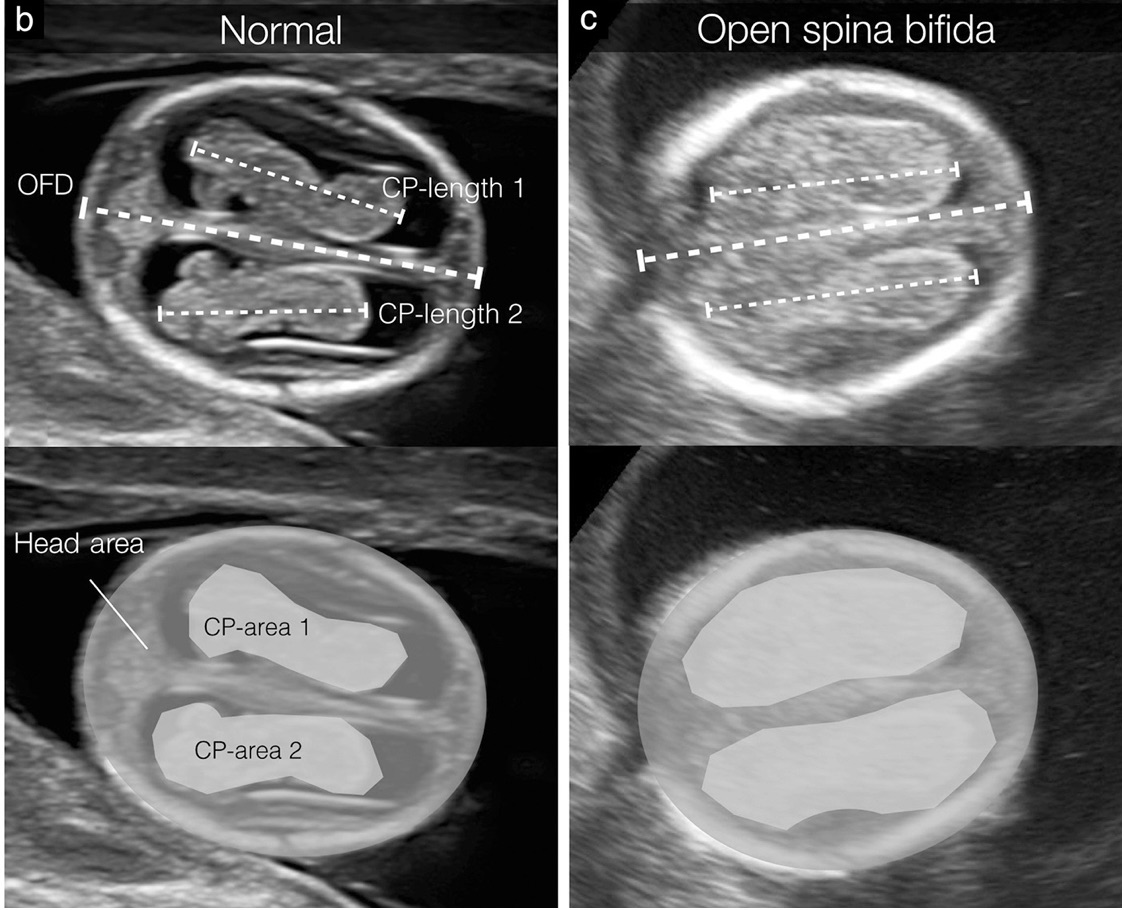 Choroid Plexus Ultrasound