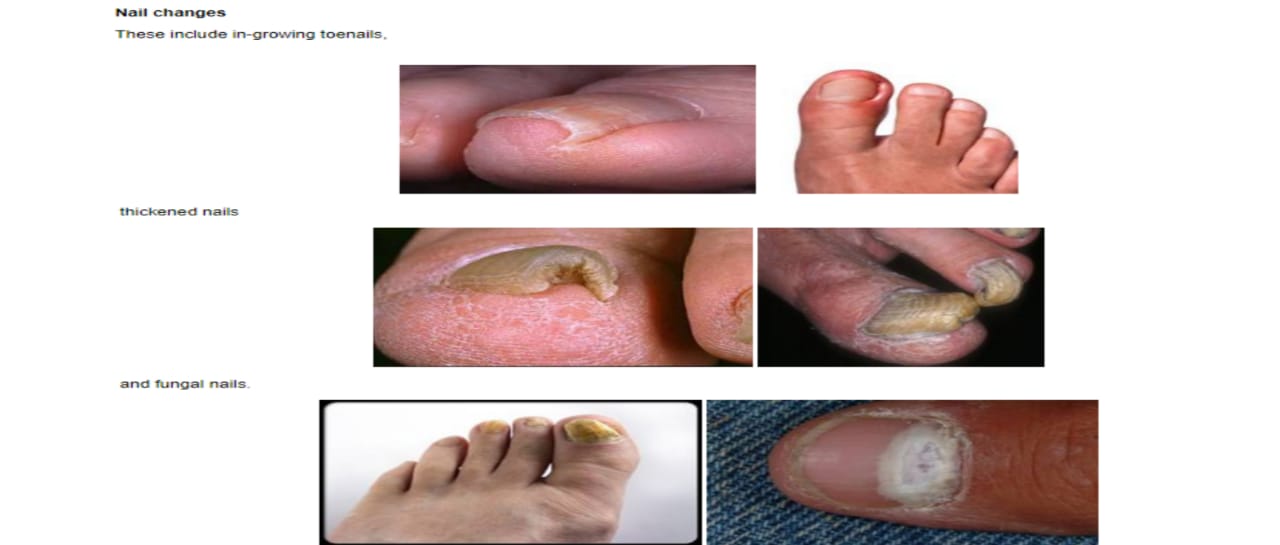 Periungual Telangiectasia