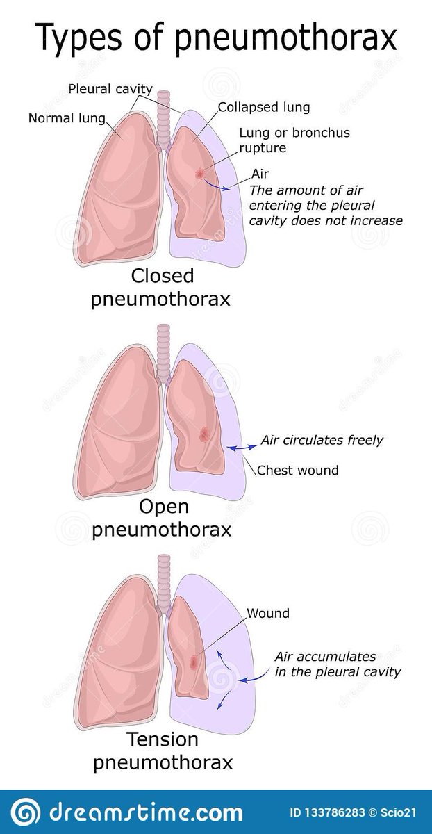 راح نتكلم لكم عن استرواح الصدر pneumothorax ايش هو ؟ مثل ما انتم شايفين ...