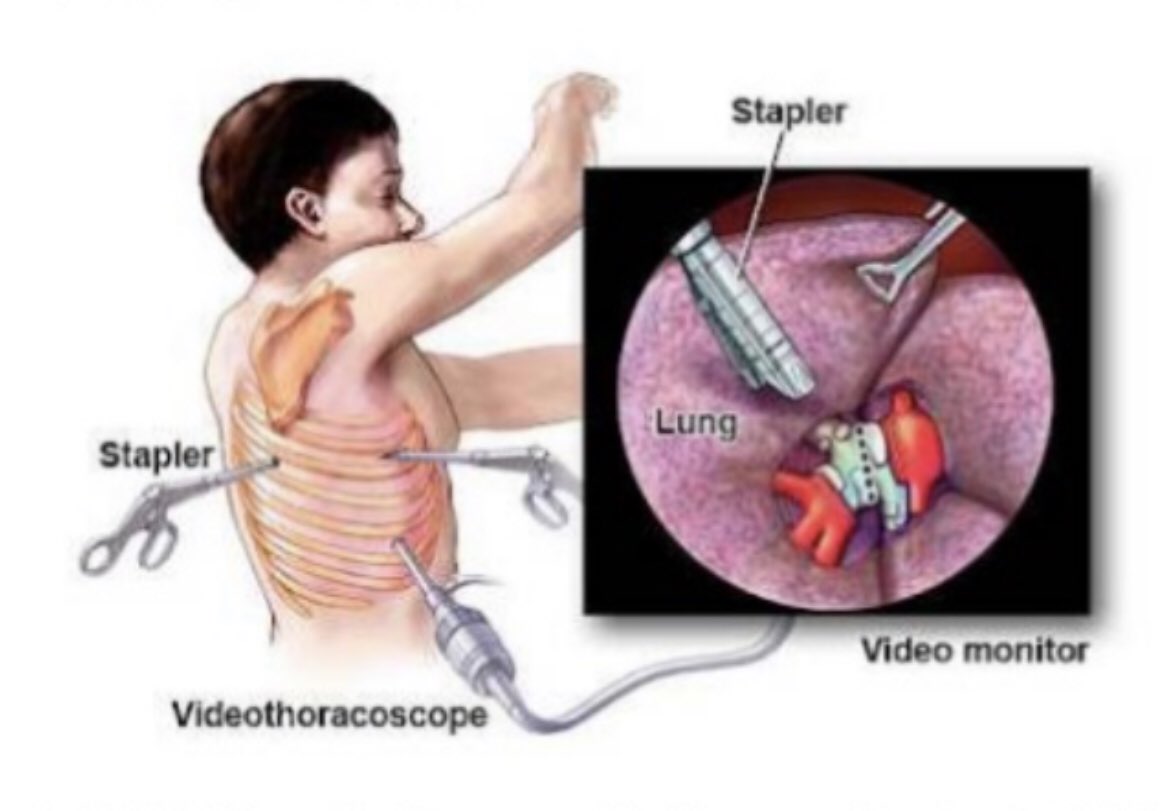 Cirbosque #SoMe4Surgery on Twitter: "Thoracoscopic and open decortication: how to do it! # ...