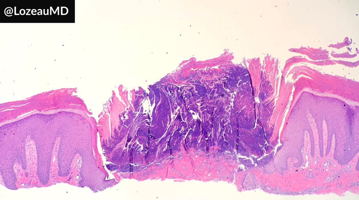 Reactive Perforating Collagenosis