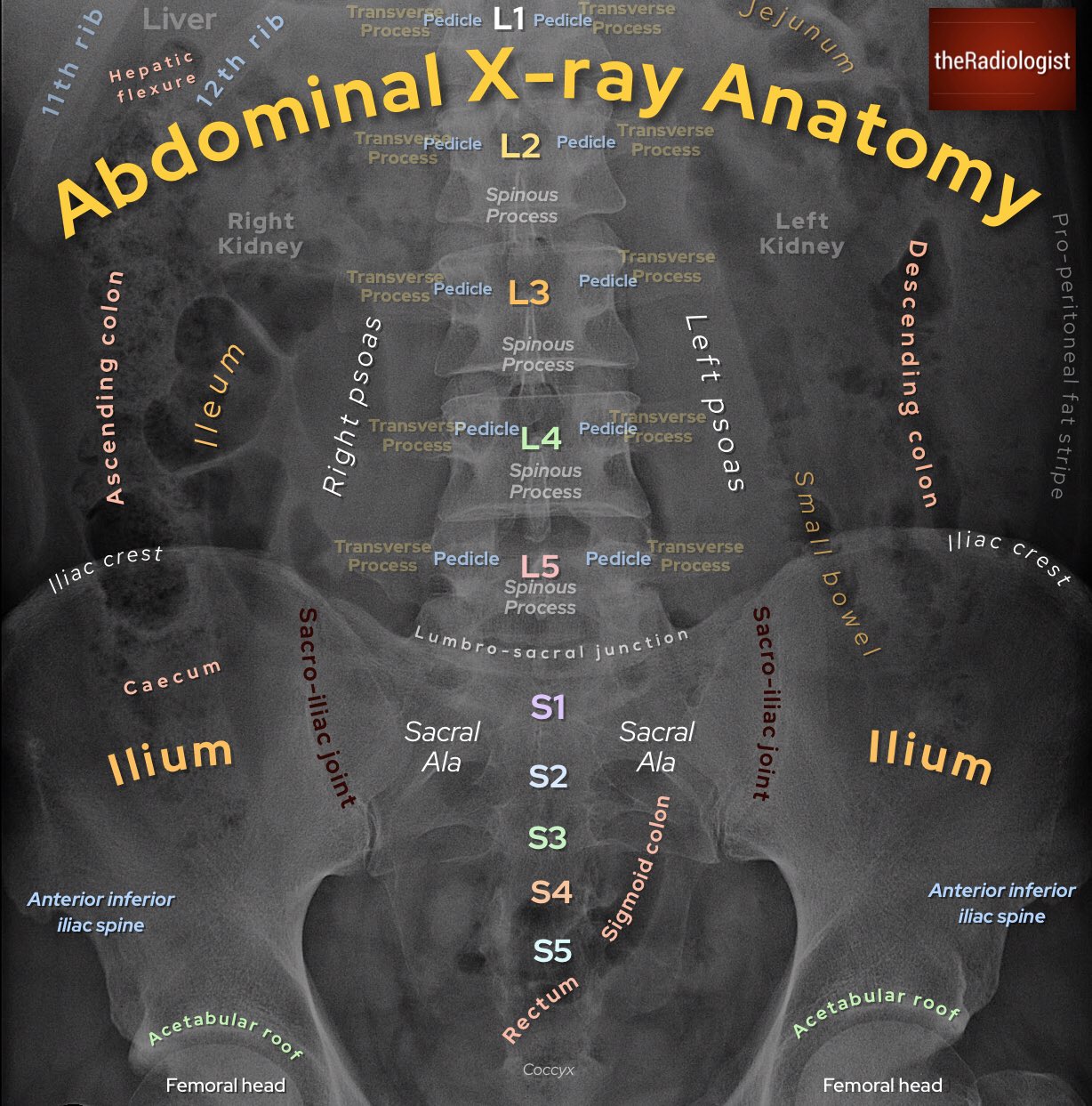 Labeled Abdominal X Ray
