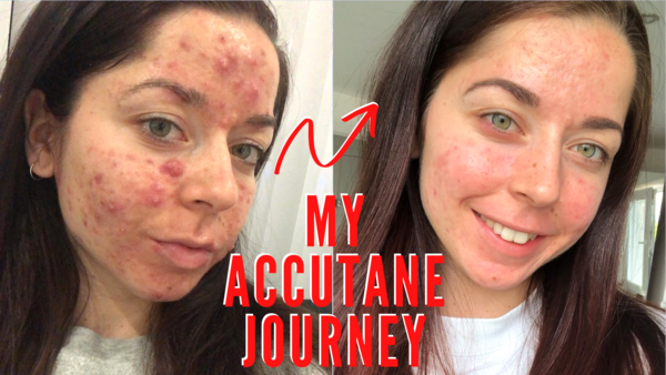 Roaccutane Side Effects