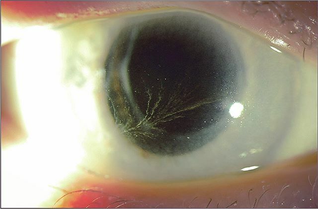 Whorl Keratopathy
