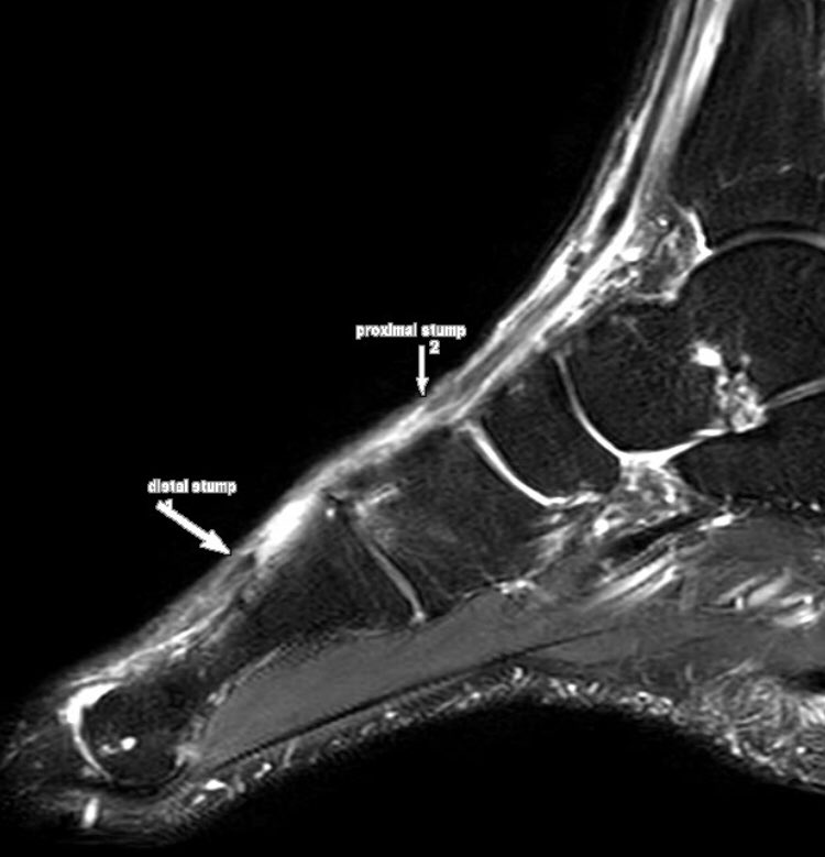Extensor Hallucis Longus Mri