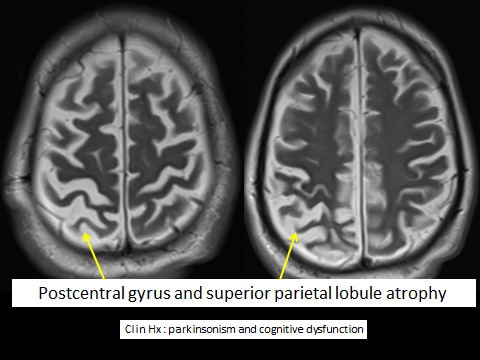 Postcentral Gyrus Mri