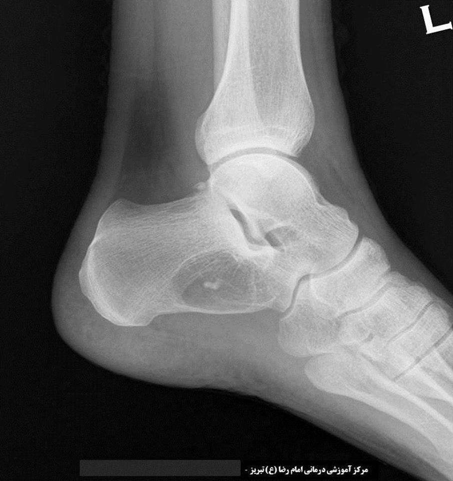 Simple Bone Cyst Fallen Fragment Sign
