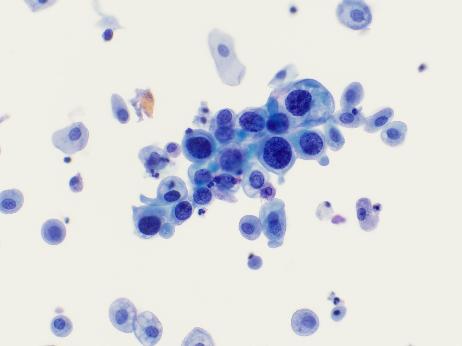 Educational Case: Urothelial Carcinoma: An Overview Of, 43% OFF