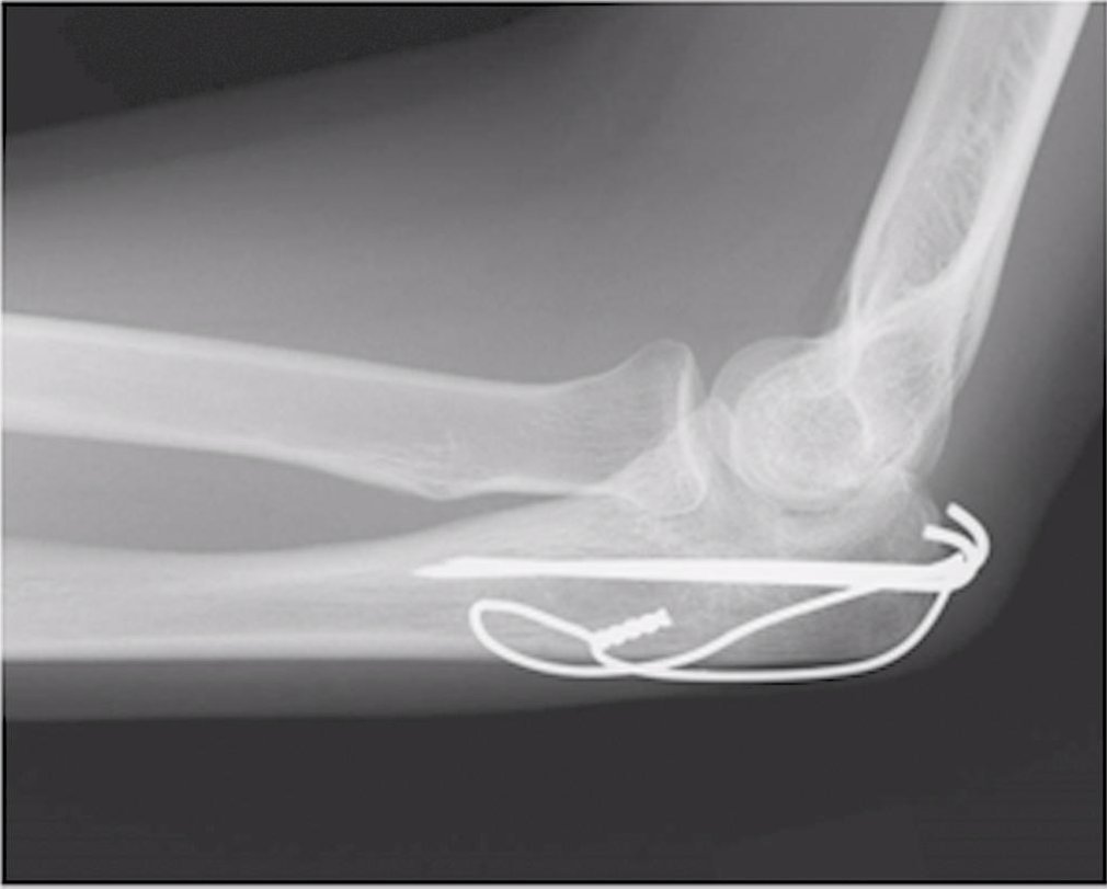 Olecranon Fracture Fixation Olecranon Fracture Fixation