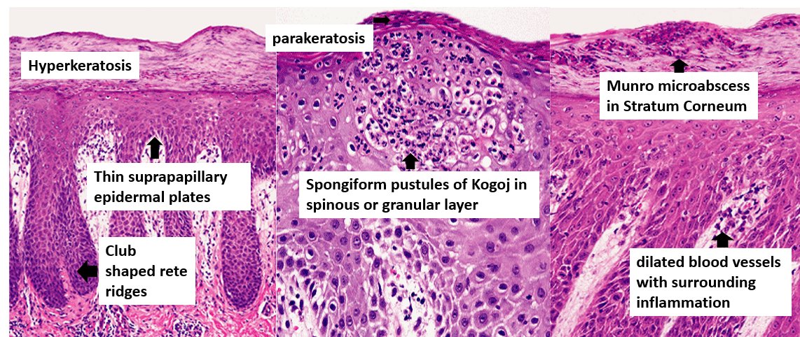Parakeratosis Psoriasis