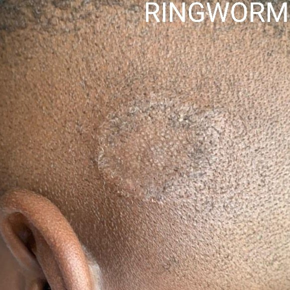 Ringworm On Black Skin