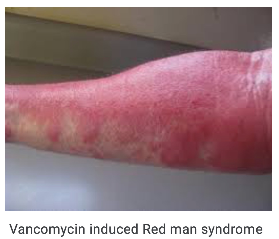 Redman Disease