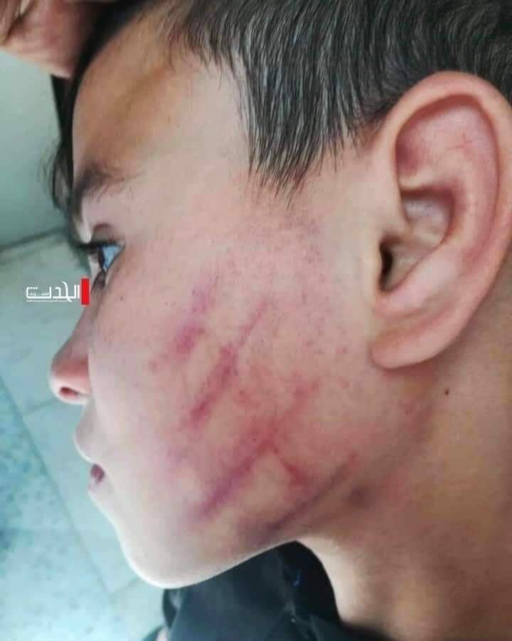 Bruised Face From Slap