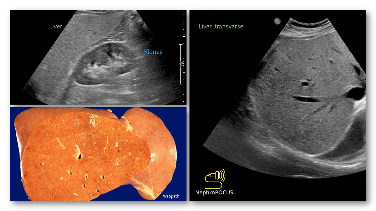 Transverse Liver Ultrasound Diaphragm
