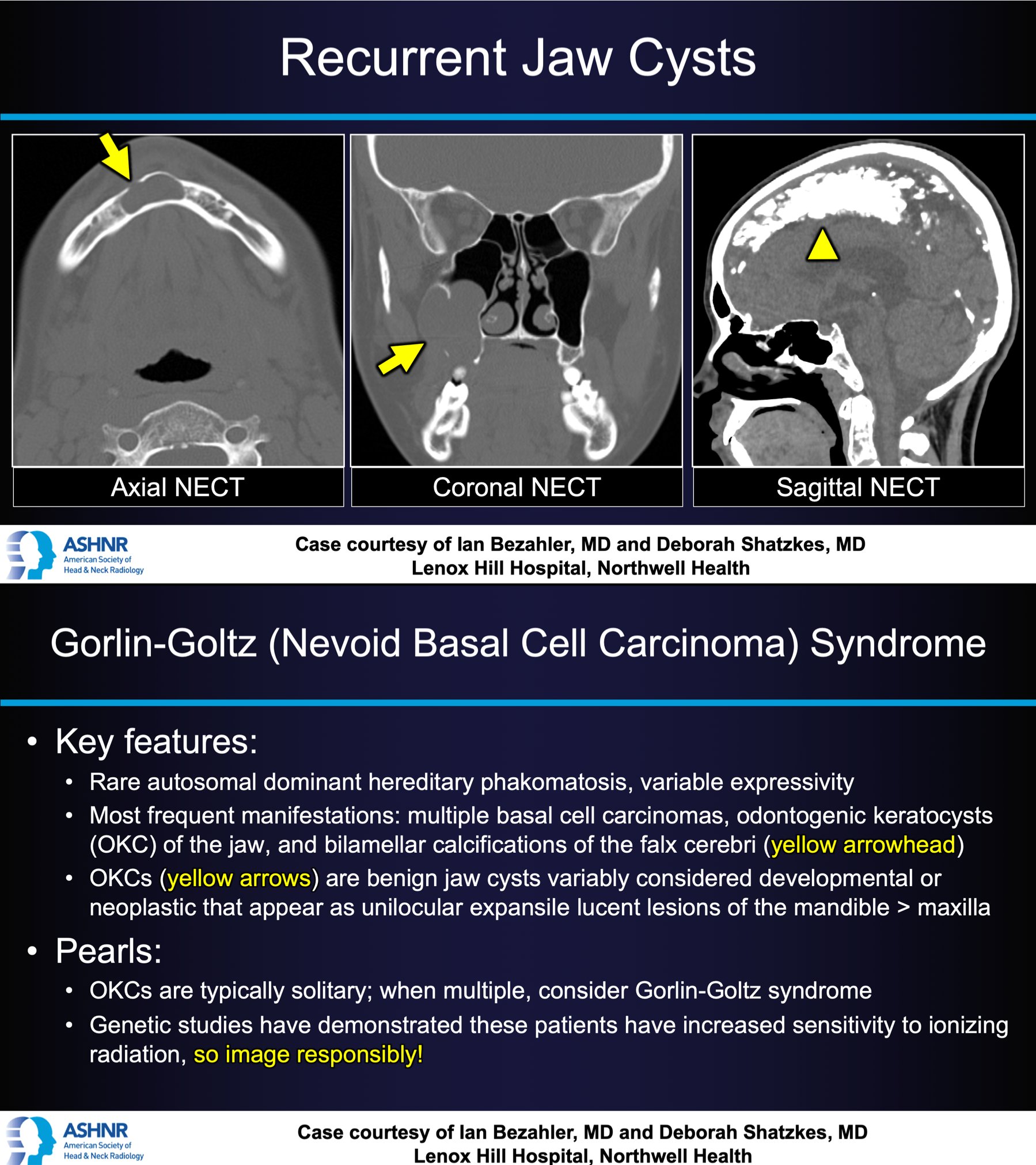 Gorlin Syndrome