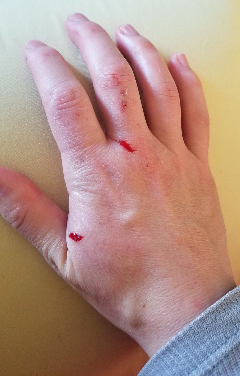 Dog Bite Hand