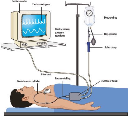 راح نتكلم لكم عن قياس الضغط عن طريق الوريد المركزي Central venous pressure ايش هو ؟ قياس ضغط ...