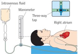 راح نتكلم لكم عن قياس الضغط عن طريق الوريد المركزي Central venous ...