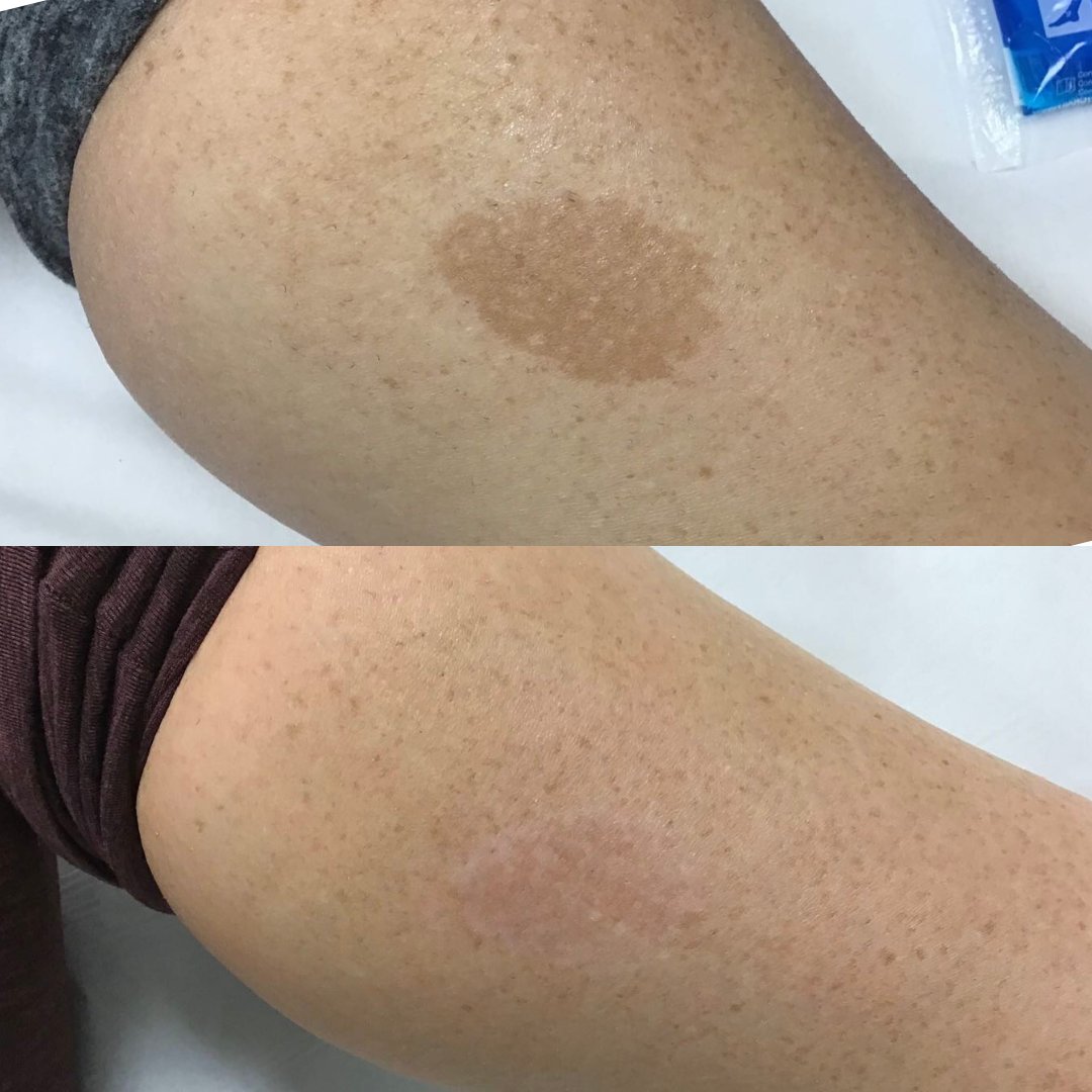 Brown Birthmark On Leg