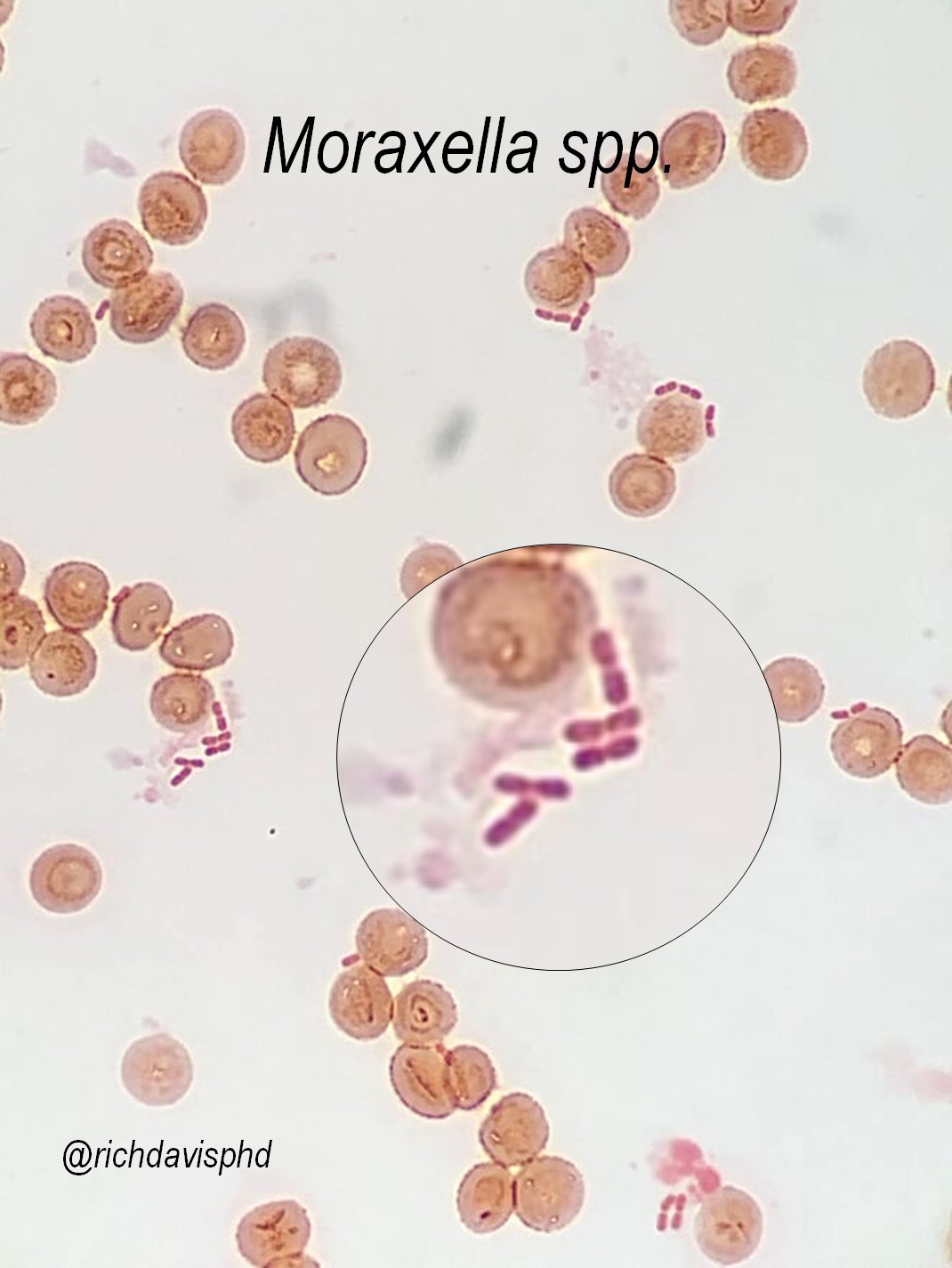 Moraxella Catarrhalis Gram Stain