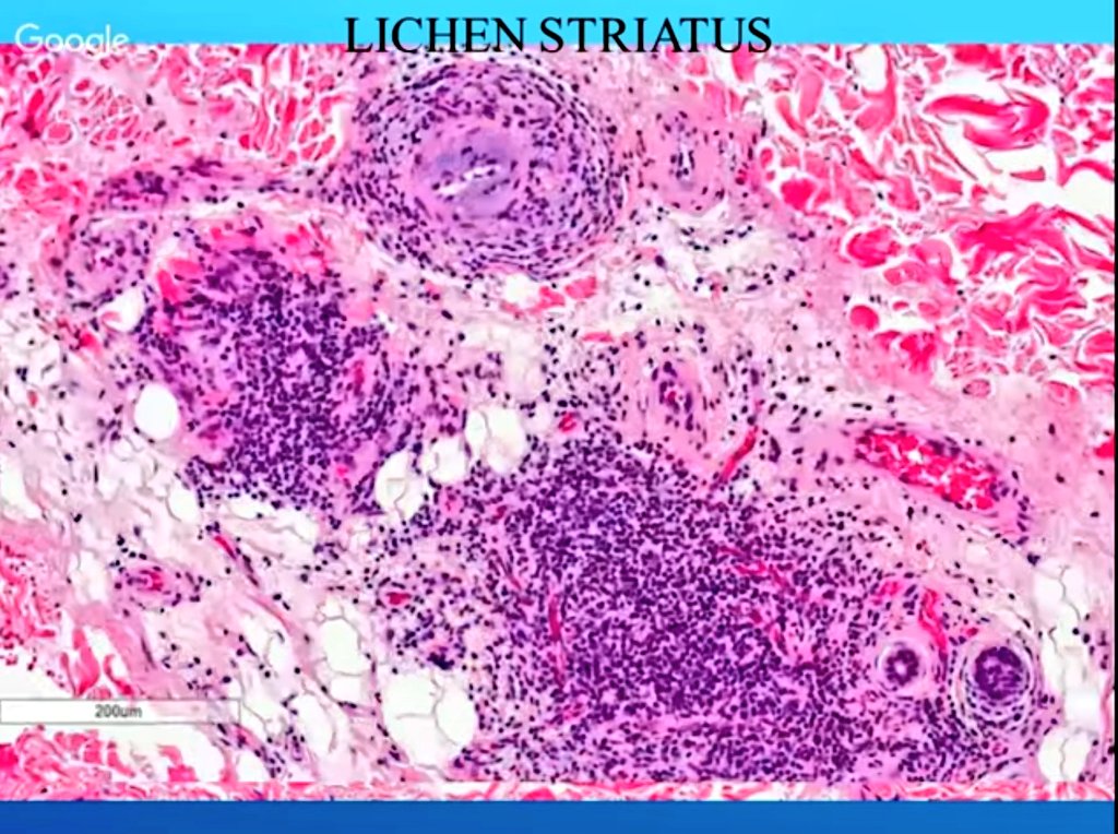 Lichen Striatus Histology