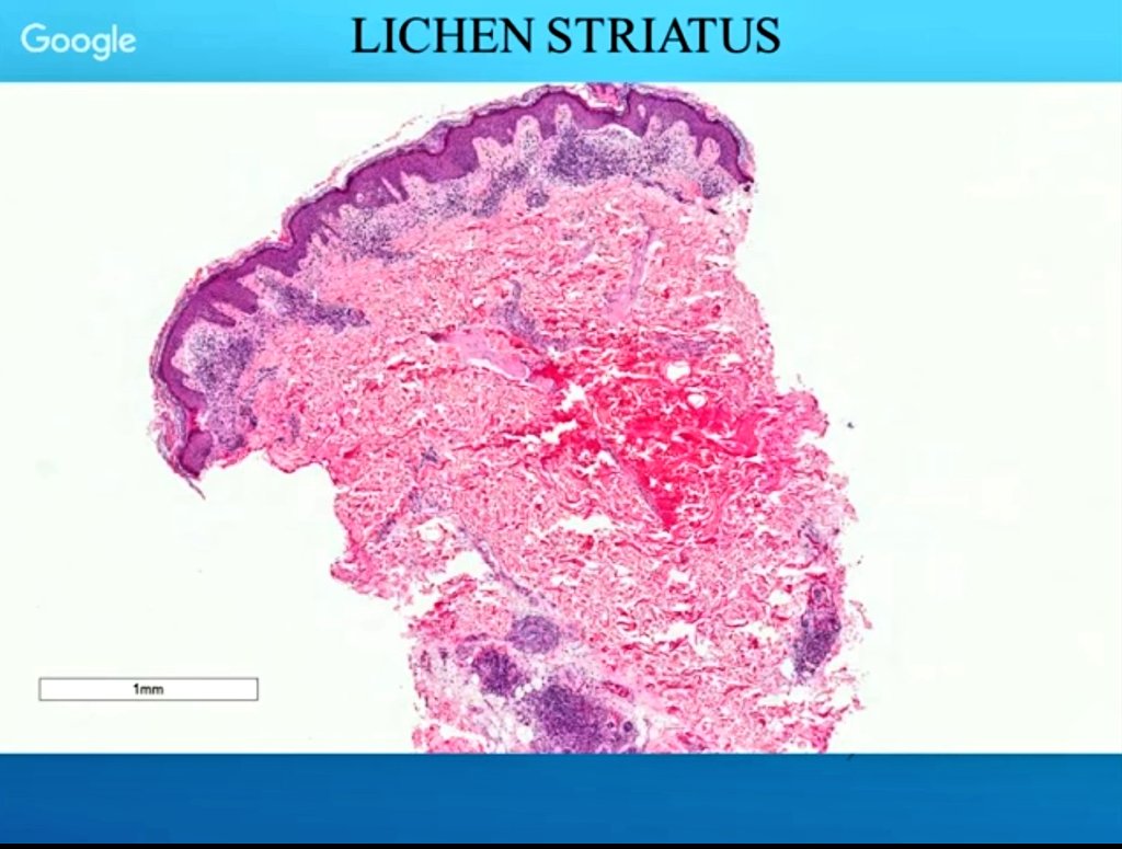 Lichen Striatus Histology