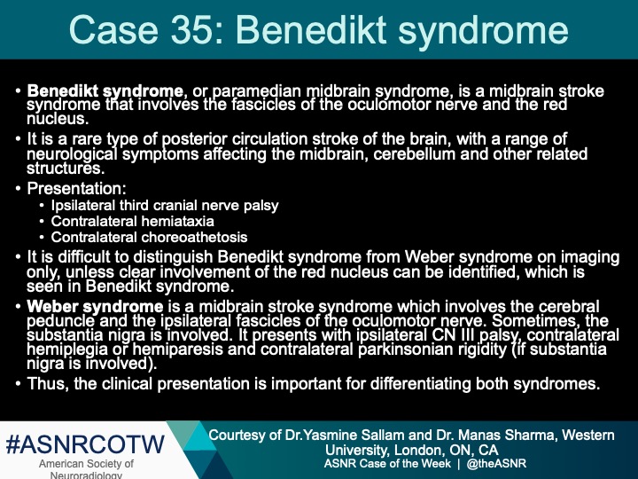 Paramedian Midbrain Syndrome