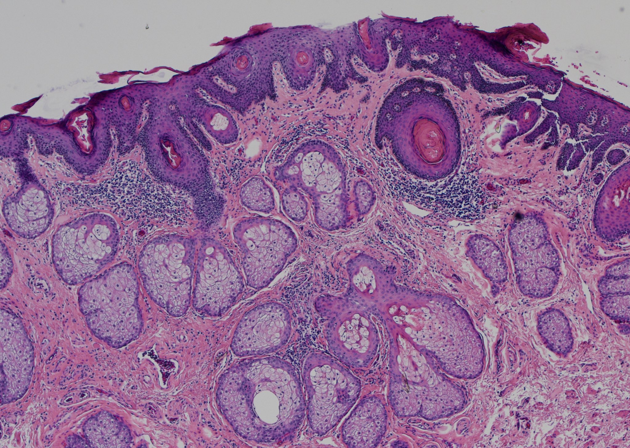 Sebaceous Glands Foreskin