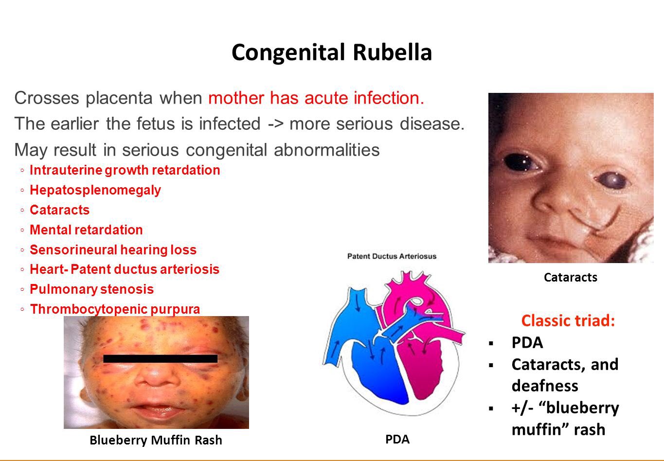 Congenital Rubella Syndrome Blueberry Muffin Rash