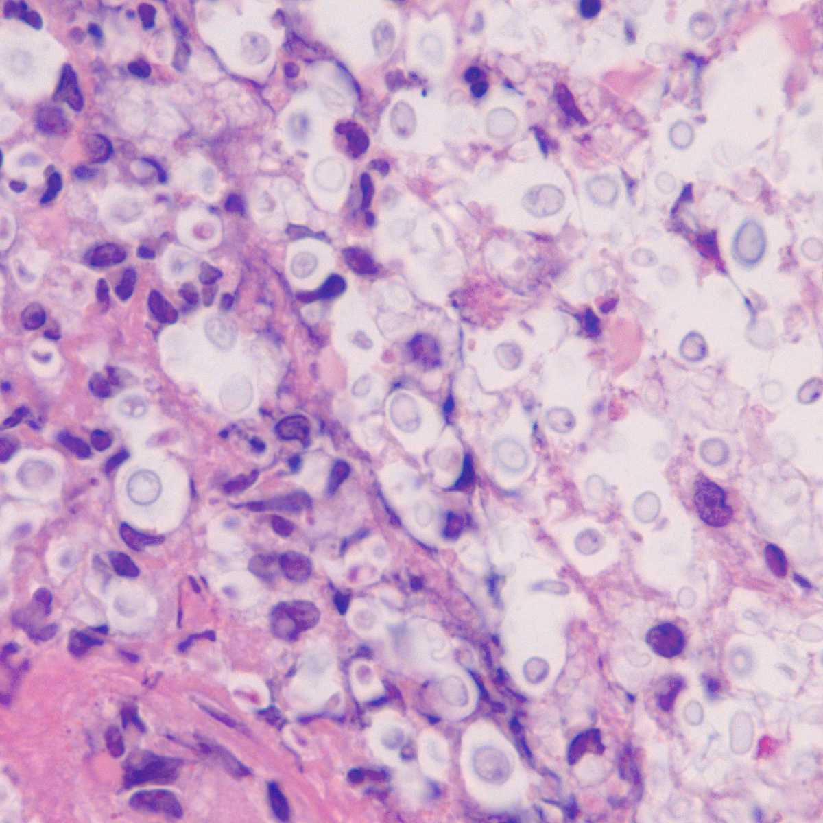 Cryptococcus Histology