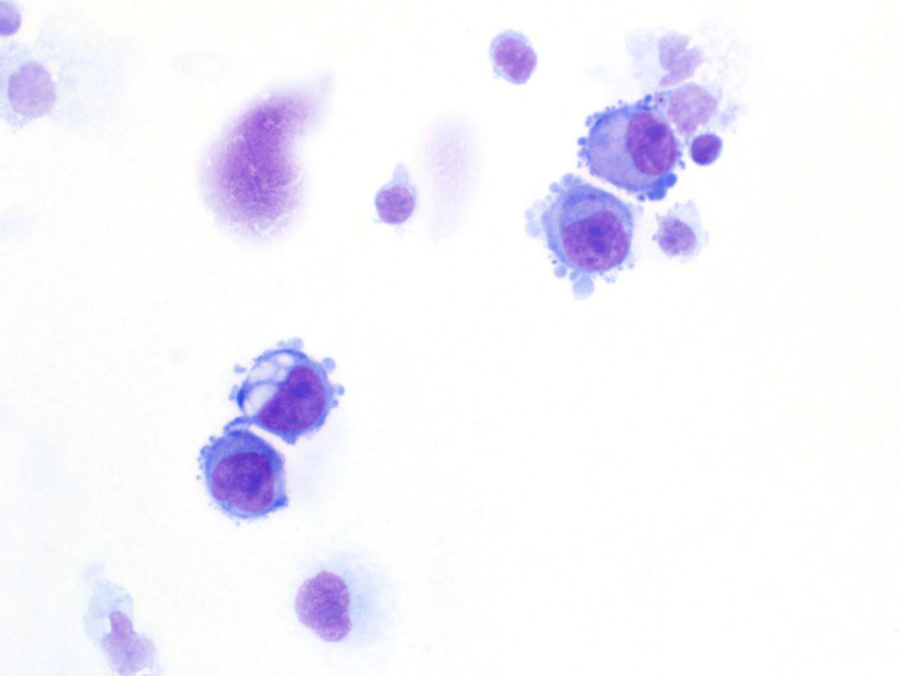 Malignant Cells In Csf