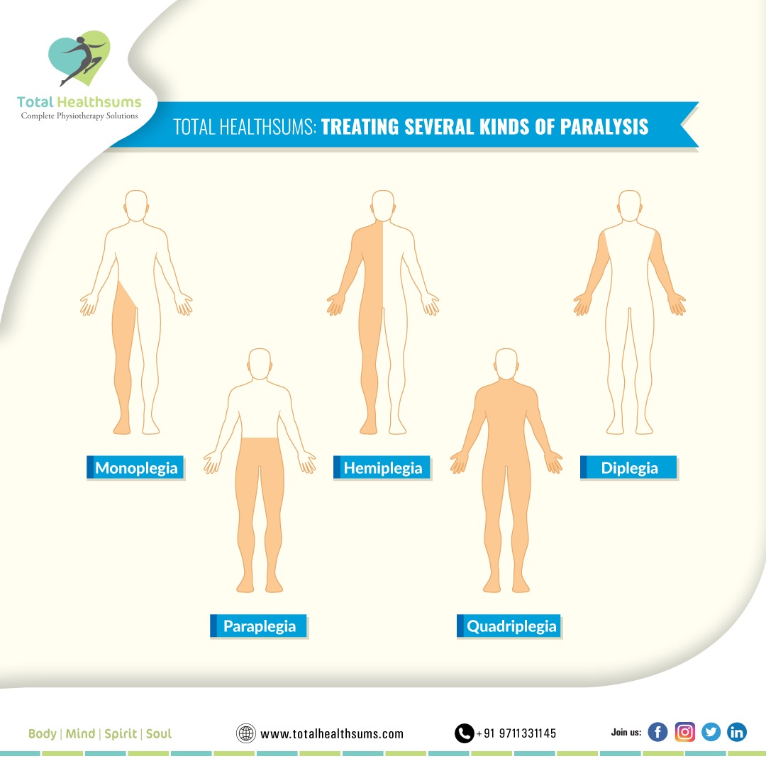 Paraplegia: Definition, Causes, Symptoms, Types Treatment, 49% OFF Paraplegia: Definition, Causes, Symptoms, Types Treatment, 49% OFF