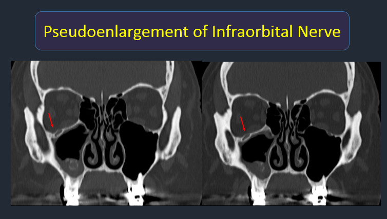Infraorbital Nerve Mri