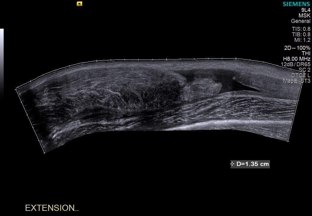 Common extensor tendon tear - The Ultrasound Site