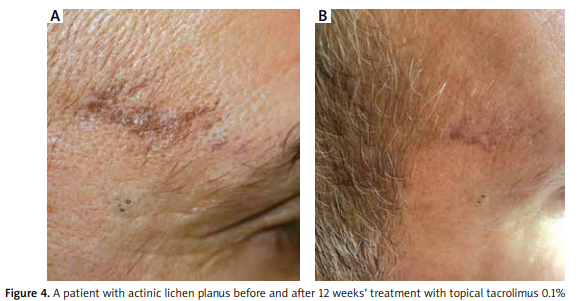 Actinic Lichen Planus