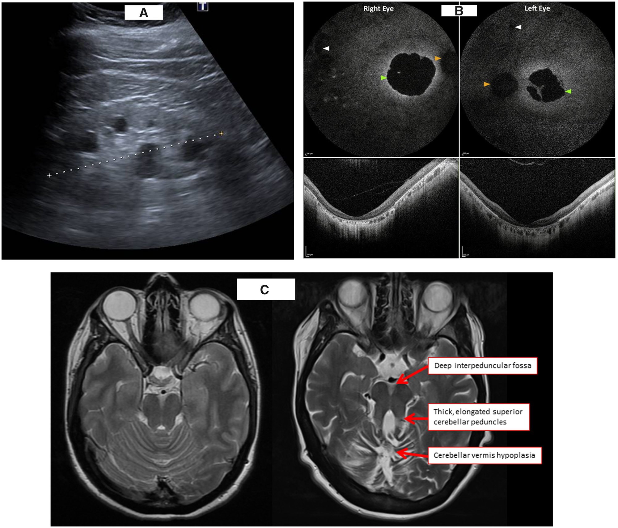 Interpeduncular Fossa Mri