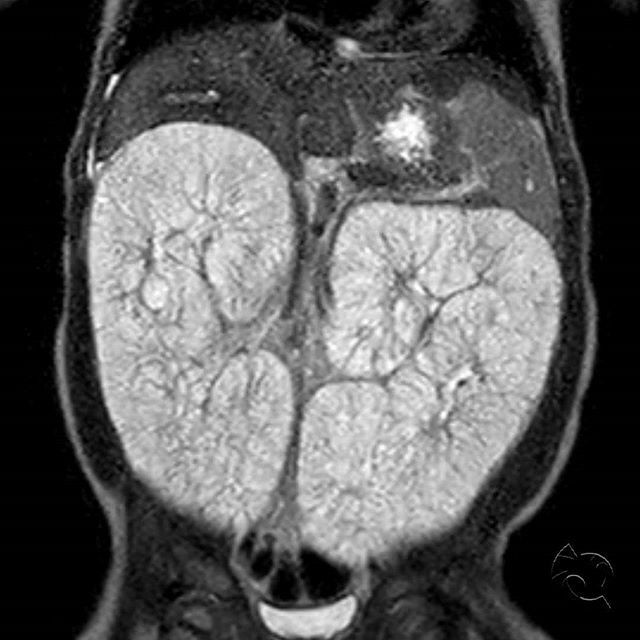 Polycystic Kidney Disease Mri