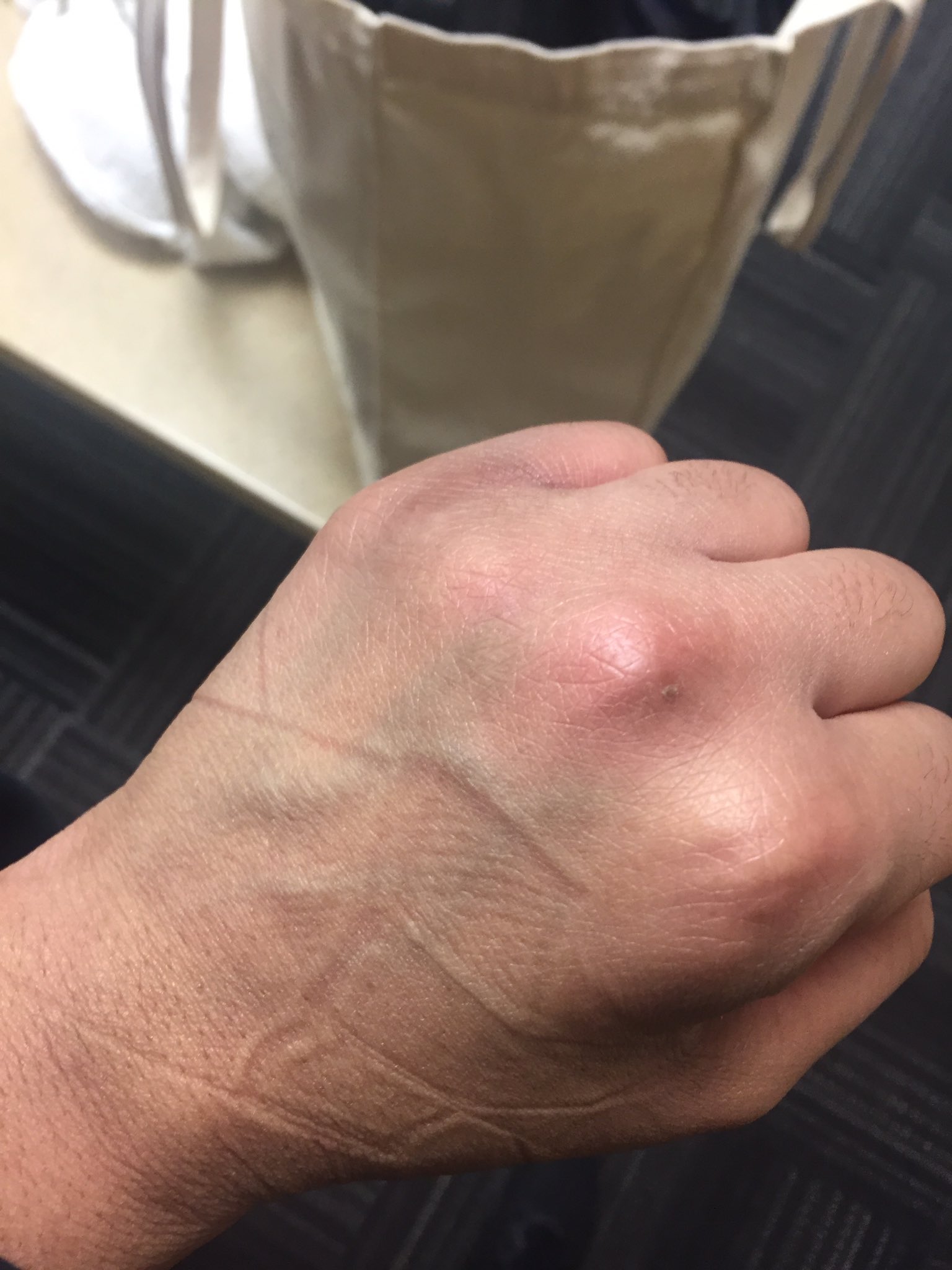 Bruised Knuckles After Boxing Hand Pain After Punching A Wall? It