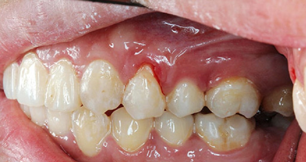 Red Dots On Gums
