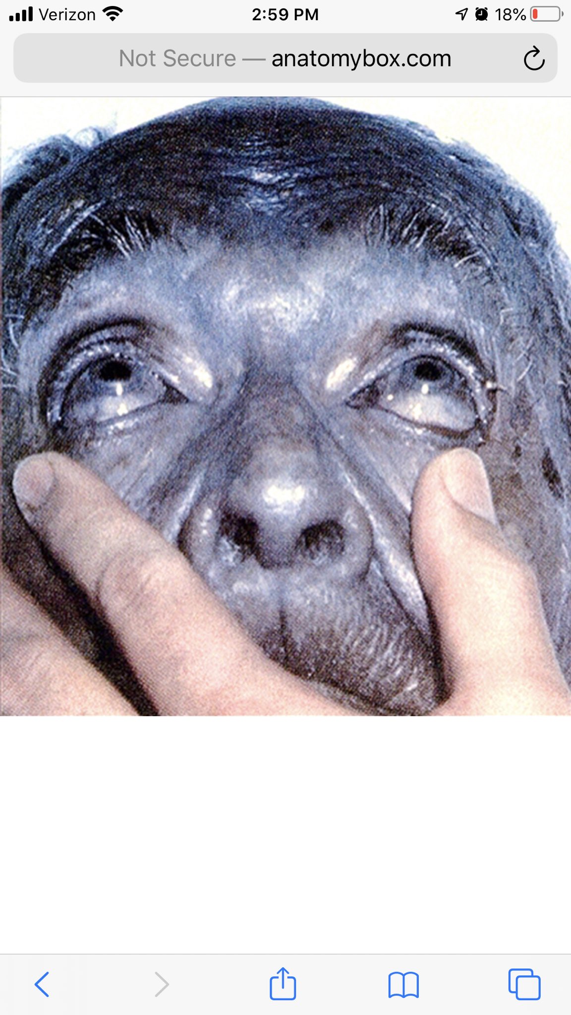 Argyria Eyes