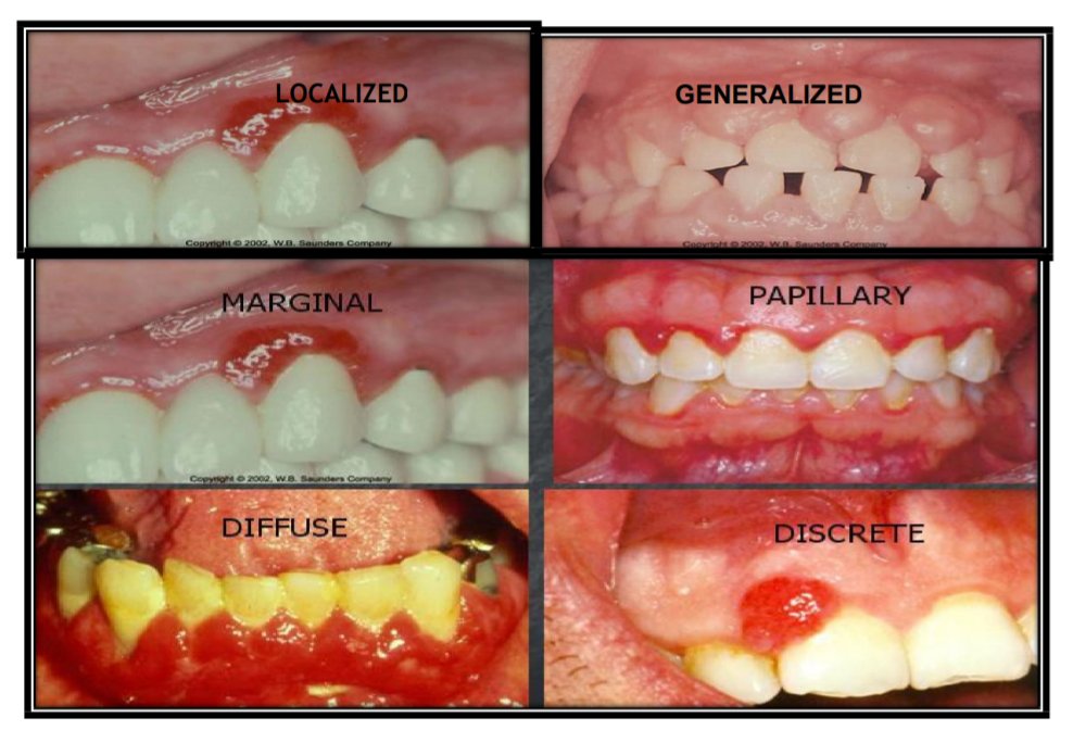 Gingival Enlargement #dental_by_hadeel - المسلسل من هديل 🕊 @Hadeel7m ...