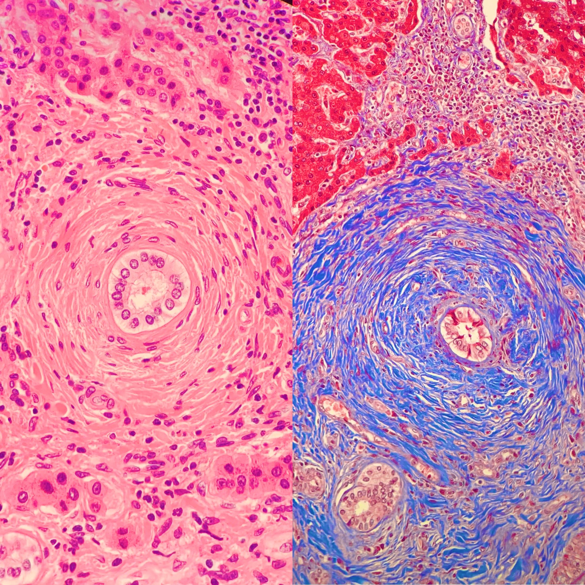 Primary Sclerosing Cholangitis Histology