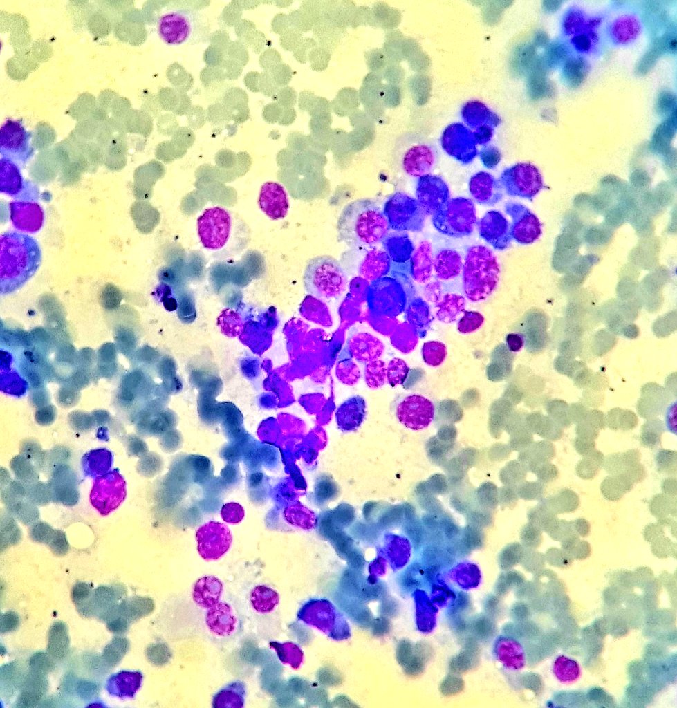 Plasma Cell Clock Face Dividing Plasma Cells In The Cerebrospinal