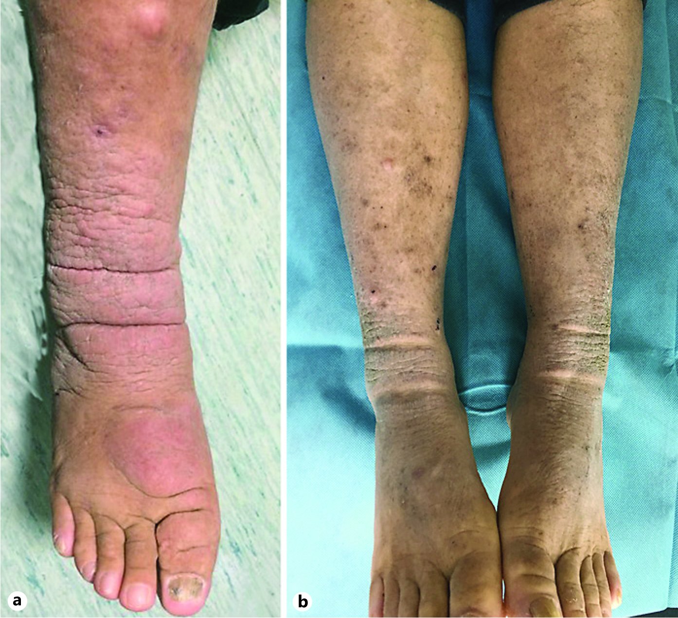 Pretibial Myxedema